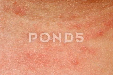 Rash skin Images - Search Images on Everypixel