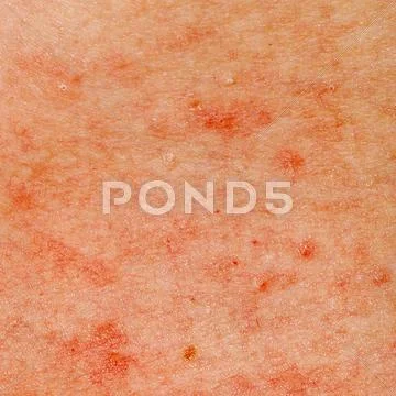 Allergic Rash Dermatitis Skin Texture - Stock Image - Everypixel
