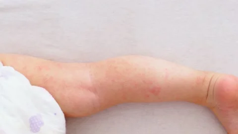 allergic skin on child's legs, red rash ... | Stock Video | Pond5