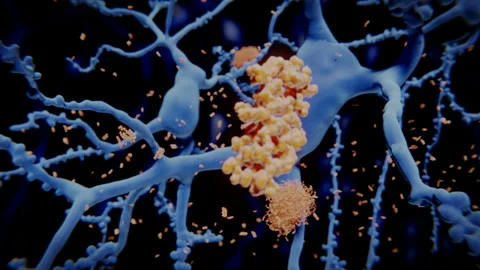 Alzheimer's disease: amyloid-beta peptid... | Stock Video | Pond5