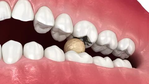 Amalgam and tooth destruction. Medically... | Stock Video | Pond5
