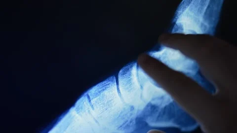 anatomical blue mri x-ray scan of a brok... | Stock Video | Pond5