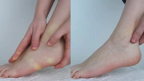 Before and after. Sole of the foot pain,... | Stock Video | Pond5