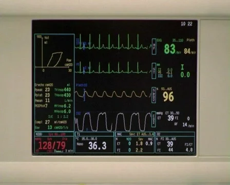 Anesthesia screen | Stock Video | Pond5