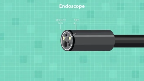 Animated Breakdown of Endoscope Tip Comp... | Stock Video | Pond5