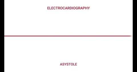 Animated EKG Display. Animated Asystole | Stock Video | Pond5