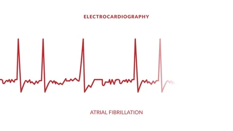 Atrial Fibrillation Ecg Stock Footage ~ Royalty Free Stock Videos | Pond5