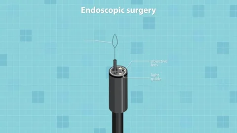 Animated Guide to Endoscopic Surgery Ins... | Stock Video | Pond5
