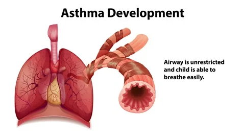 Animation of Asthma Development with Exp... | Stock Video | Pond5