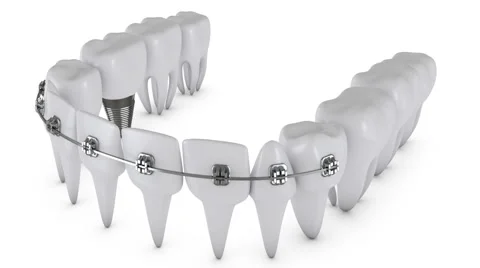Animation dental brackets | Stock Video | Pond5