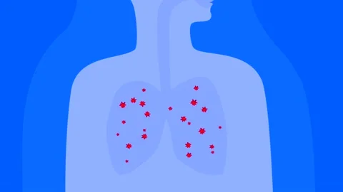 Respiratory Disease Stock Footage ~ Royalty Free Stock Videos | Pond5