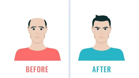 Hair Transplant Animation Stock Footage ~ Royalty Free Stock Videos | Pond5