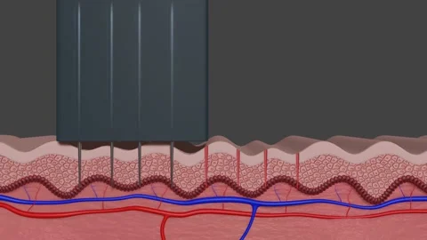 Animation of scar treatment with micro n... | Stock Video | Pond5