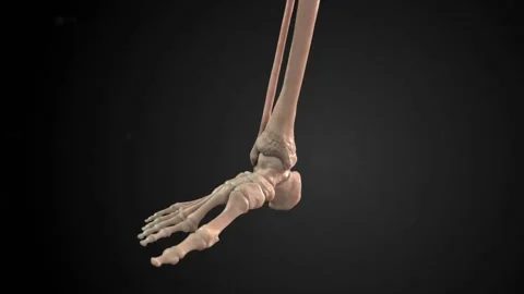 Ankle fracture animation. The fibula hel... | Stock Video | Pond5