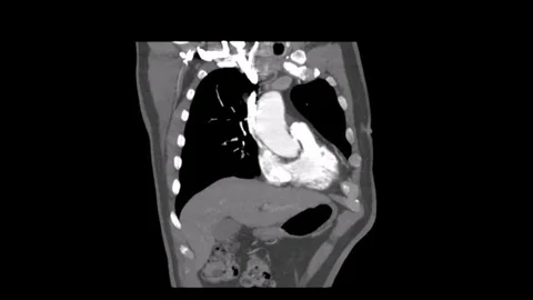 Arterial phase in oblique of an Angiotac... | Stock Video | Pond5