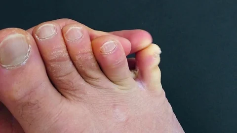 athlete's foot, ringworm between the toe... | Stock Video | Pond5