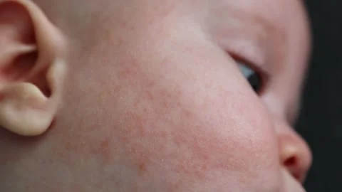 atopic dermatitis rush allergic skin on ... | Stock Video | Pond5