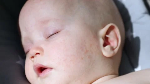 atopic dermatitis rush allergic skin on ... | Stock Video | Pond5