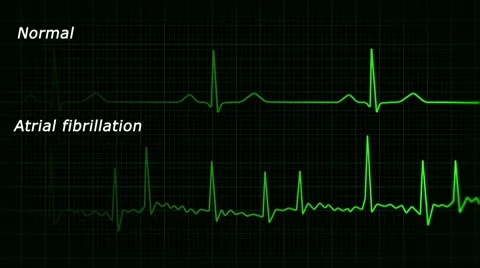 Atrial Fibrillation Stock Footage ~ Royalty Free Stock Videos | Pond5