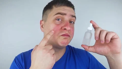 Azelaic acid. Man applies azelainates to... | Stock Video | Pond5