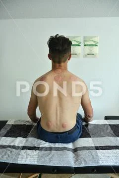 Back view of a young man after hijama treatment Stock Photo #146726825