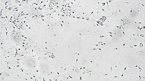 Bad spermogram of male semen under micro... | Stock Video | Pond5