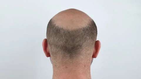 Bald man, rear view. Baldness close-up. ... | Stock Video | Pond5