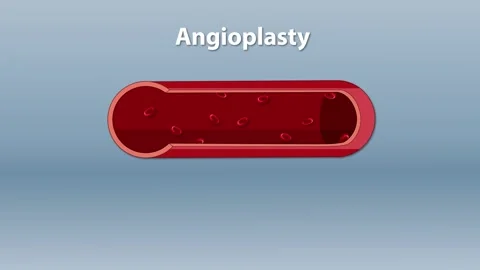 Balloon Angioplasty Procedure Animation | Stock Video | Pond5