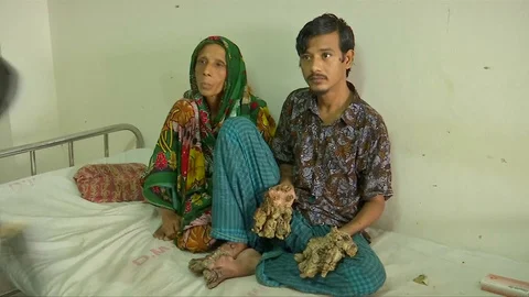 Bangladeshi man suffering from 'treeman ... | Stock Video | Pond5