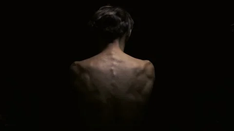 Scoliosis Stock Video Footage | Royalty Free Scoliosis Videos | Pond5