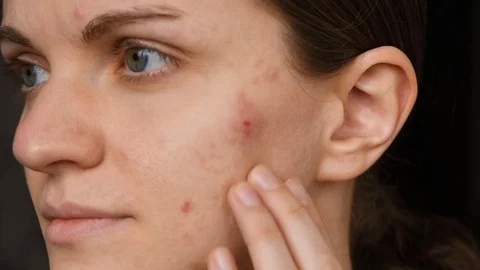 Acne Stock Footage ~ Royalty Free Stock Videos | Pond5