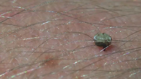 Bee's venom sac. Honey bee stings a man'... | Stock Video | Pond5