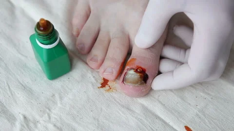 Wound Injury Stock Videos – Royalty-Free HD & 4K Videos | Pond5