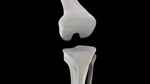 Knee Replacement Stock Footage ~ Royalty Free Stock Videos | Pond5