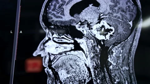 Black and white MRI shot on the big scre... | Stock Video | Pond5