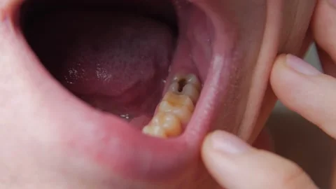 Black Tooth Caries | Stock Video | Pond5