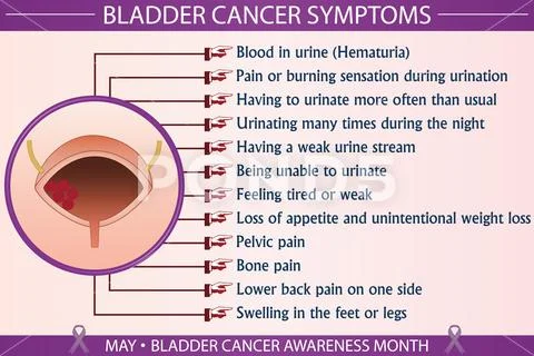 Bladder Cancer Symptoms Infographic Vector Illustration Illustration ...