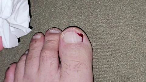 Swollen Toe Stock Video Footage | Royalty Free Swollen Toe Videos | Pond5