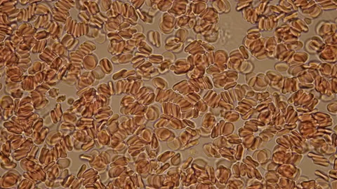 Haemoglobin Stock Video Footage | Royalty Free Haemoglobin Videos | Pond5