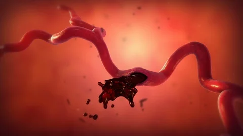 Burst Blood Vessel Stock Videos – Royalty-Free HD & 4K Videos