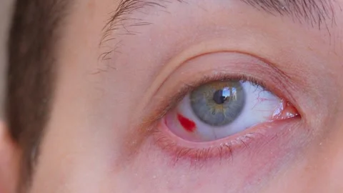 Injury Bleeding Stock Footage ~ Royalty Free Stock Videos | Pond5