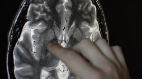 blue mri x ray scan of human brain. | Stock Video | Pond5