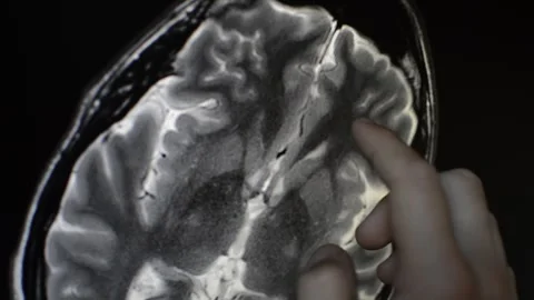 blue mri x ray scan of human brain. | Stock Video | Pond5