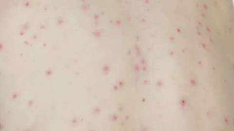 Body of adult man have spotted, red pim... | Stock Video | Pond5