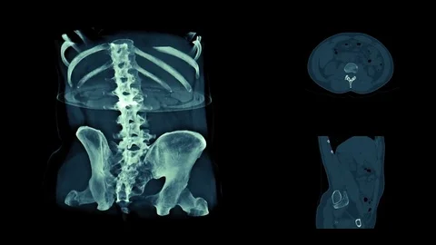 Body CT scan image, radiography x-ray ex... | Stock Video | Pond5