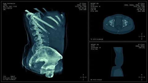 Body CT scan image, radiography x-ray ex... | Stock Video | Pond5