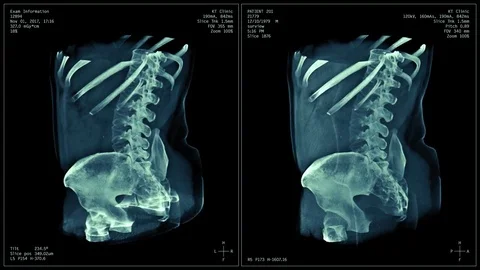 Body CT scan image, radiography x-ray ex... | Stock Video | Pond5