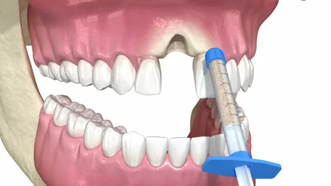 Bone grafting augmentation, socket prese... | Stock Video | Pond5
