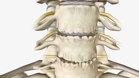 Bone spurs, or osteophytes, are bony gro... | Stock Video | Pond5