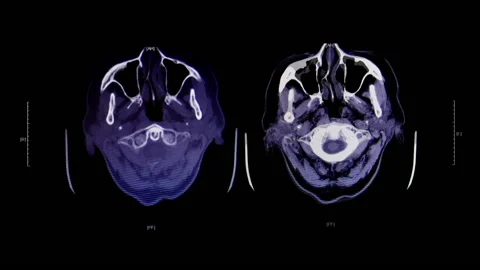 Brain Cat Scans & Cranial X-Rays analyze... | Stock Video | Pond5